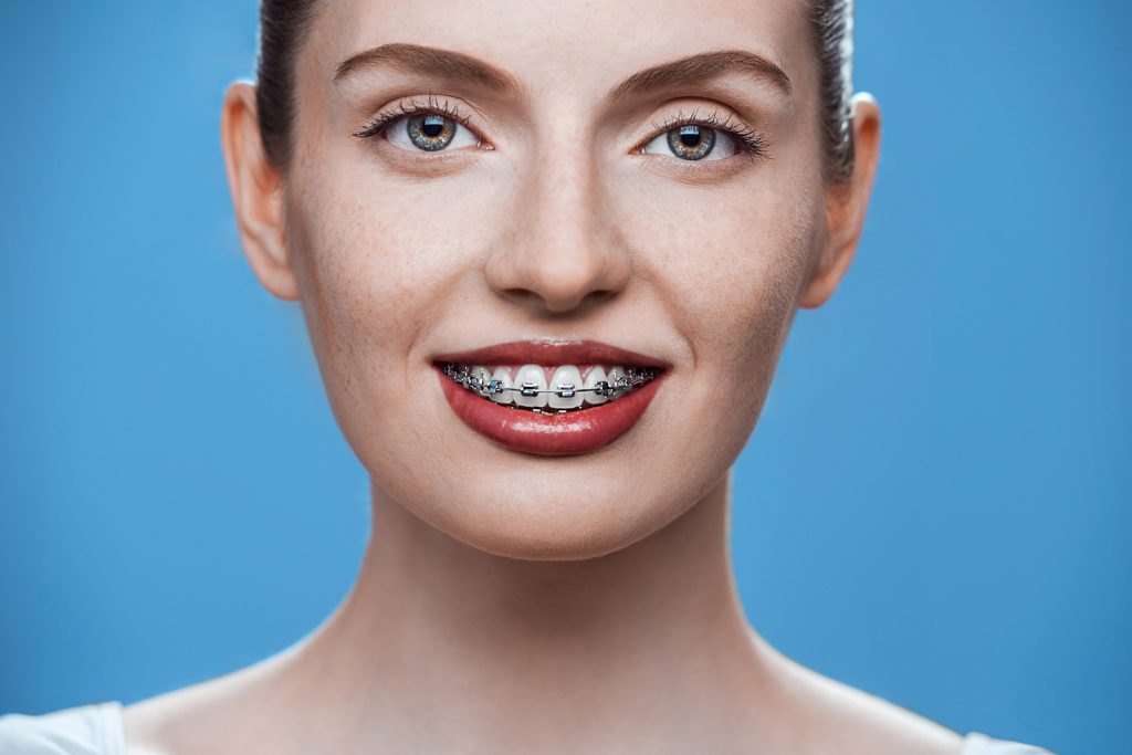Ponerse Brackets Cuando Se Es Adulto
