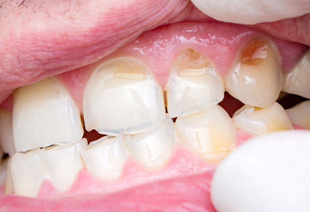 La hipoplasia del esmalte dental I Drs Moreno-Montalvo